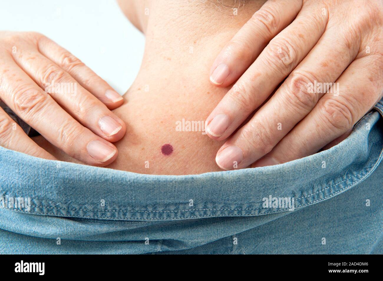 Mole. Close-up of a mole on the neck of a 73-year-old woman. Moles are ...