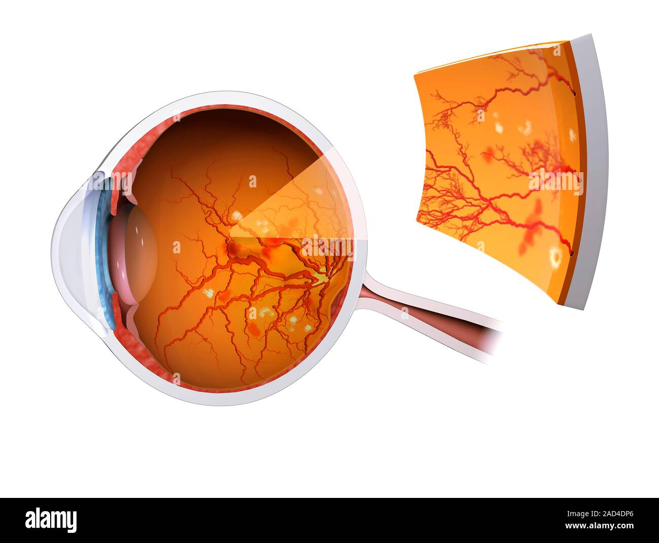Eye damage due to diabetes. Illustration of a cross-section through a ...