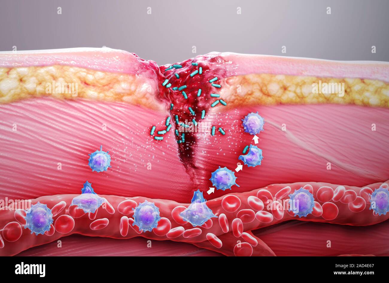 Skin damage immune response. Cutaway computer artwork showing the body ...