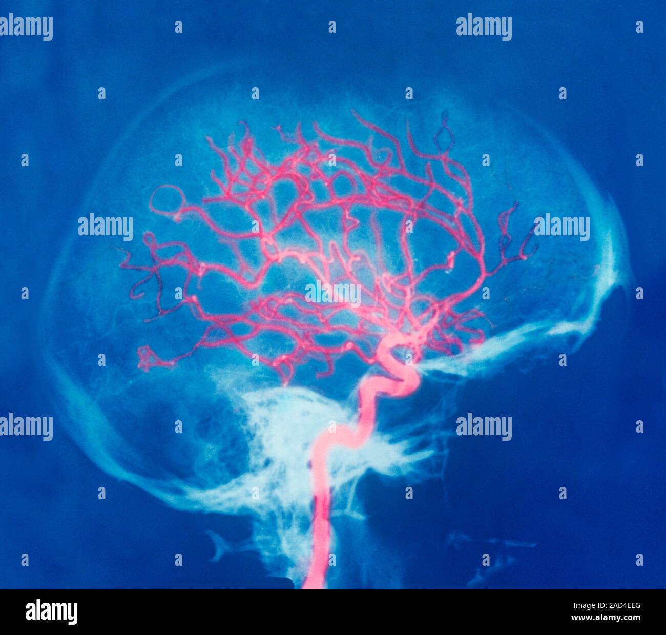 Blood supply to the head, X-ray. Angiogram of a normal head, showing ...