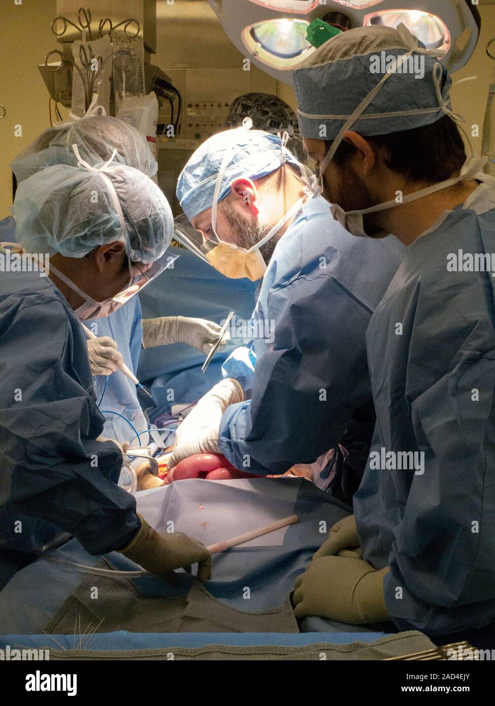 Distended colon explorative laparotomy. Surgeons performing an ...