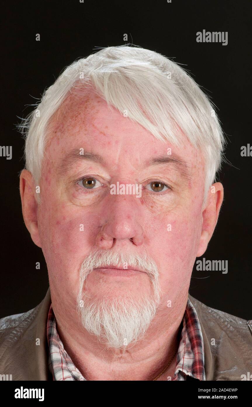 Rhinophyma. Thickened tissue around on the nose of a 63-year-old male ...