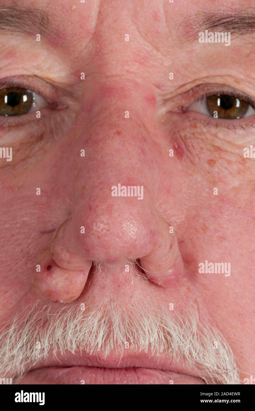Rhinophyma. Thickened tissue around on the nose of a 63-year-old male ...