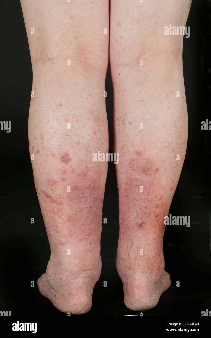 Bowens Disease Skin Cancer Lesions On The Legs Of A 74 Year Old Female Patient With Bowens