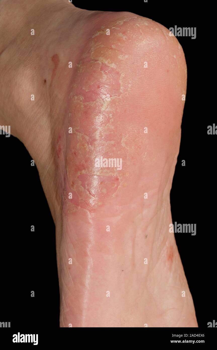 Psoriasis. Close-up of psoriasis affecting the foot of a 35-year-old ...