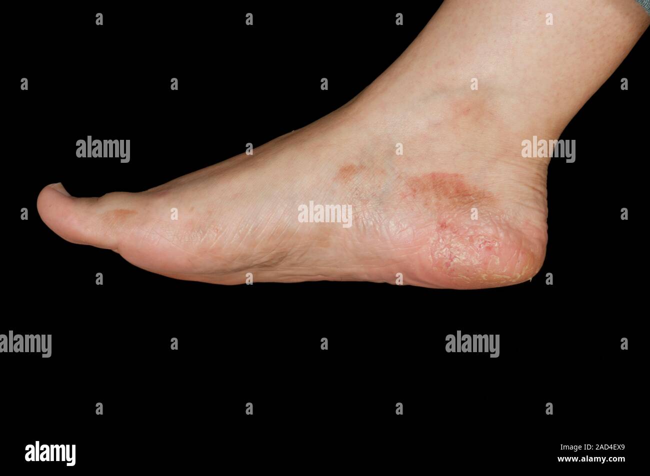 Psoriasis. Close-up of psoriasis affecting the foot of a 35-year-old ...