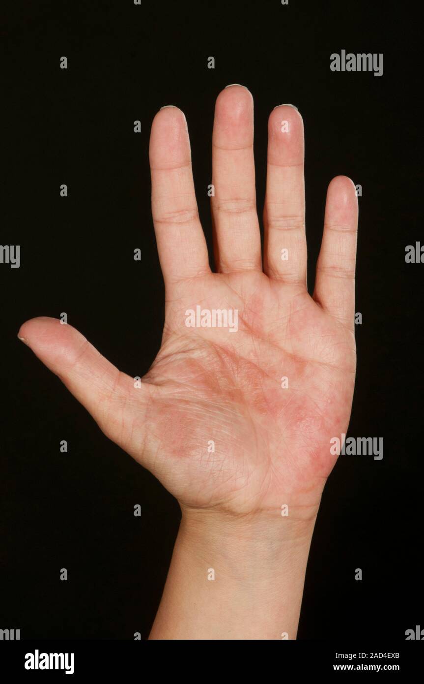 Psoriasis. Close-up of psoriasis affecting the hand of a 35-year-old ...