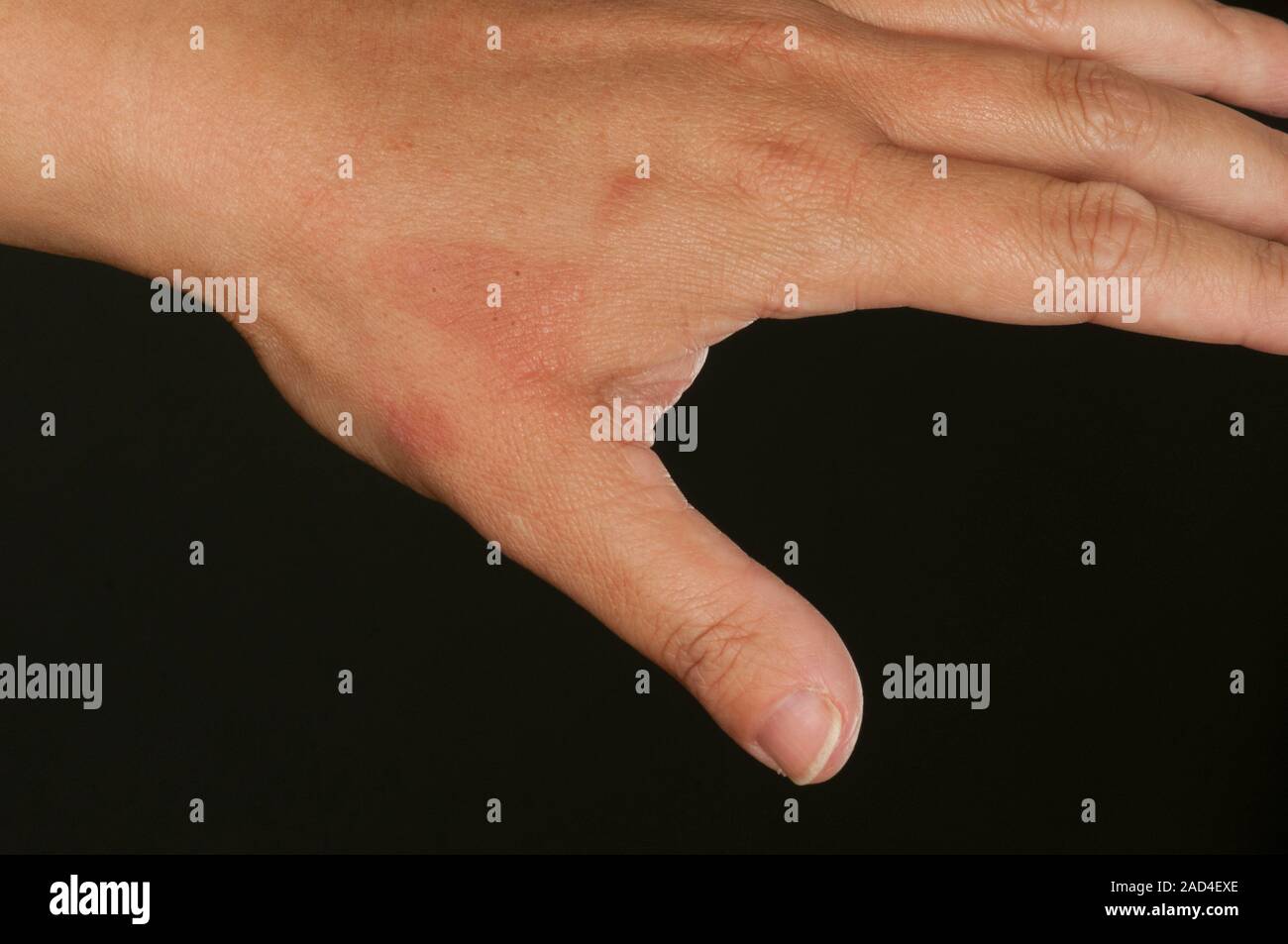 Psoriasis. Close-up of psoriasis affecting the hand of a 35-year-old ...