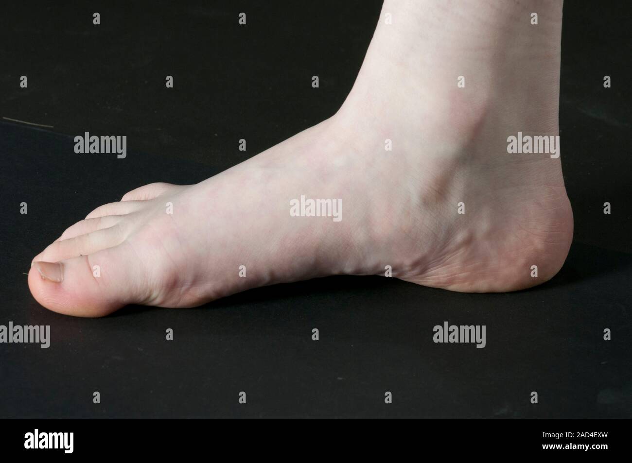 Pedal Papules. Close-up of the foot of a 14-year-old female patient ...