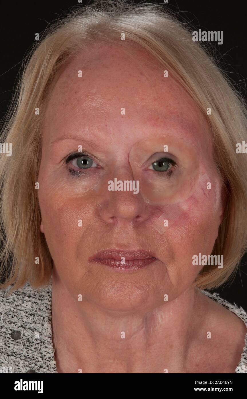 Eye removed in skin cancer. Close-up of the face of a 65-year-old ...