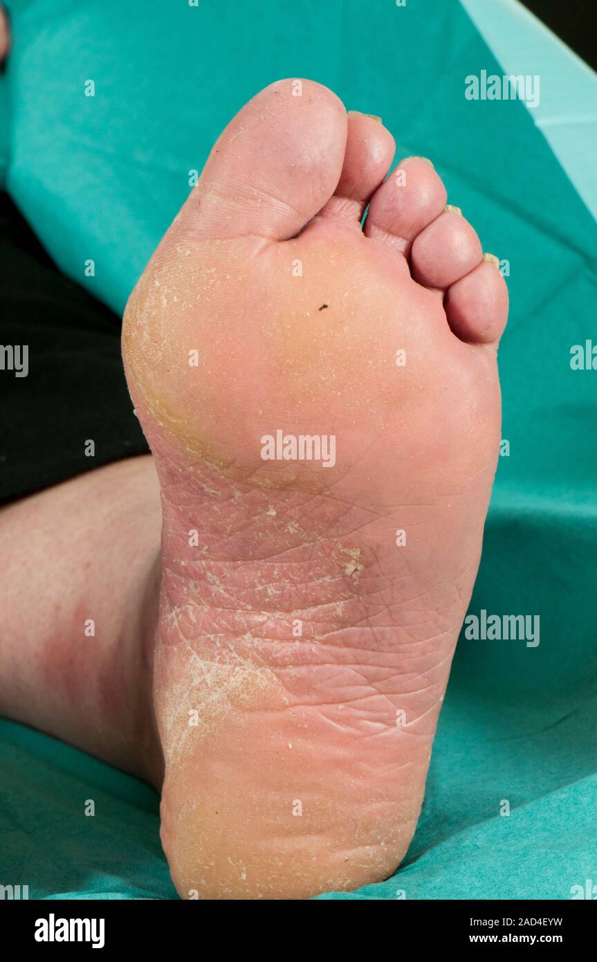 Palmar plantar erythrodysesthesia. Close-up of reddened peeling skin on ...