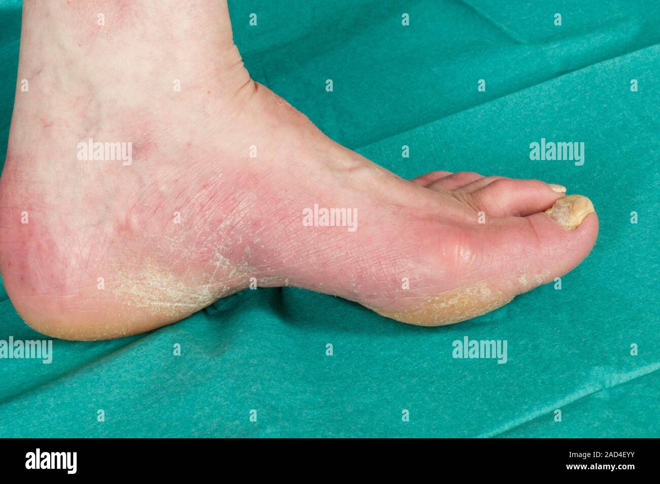 Palmar plantar erythrodysesthesia. Close-up of reddened peeling skin on ...