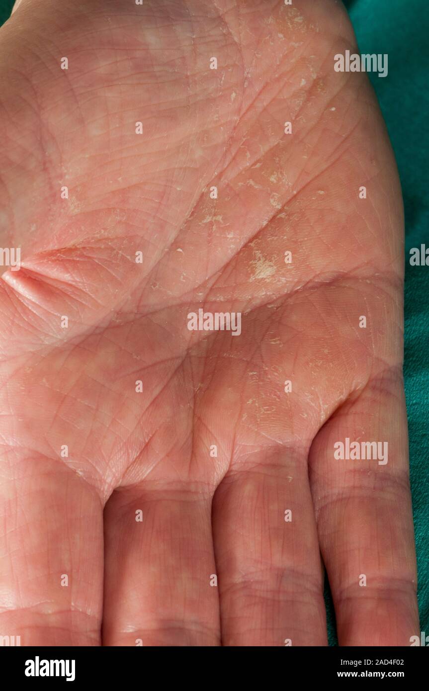 Palmar plantar erythrodysesthesia. Close-up of reddened peeling skin on ...