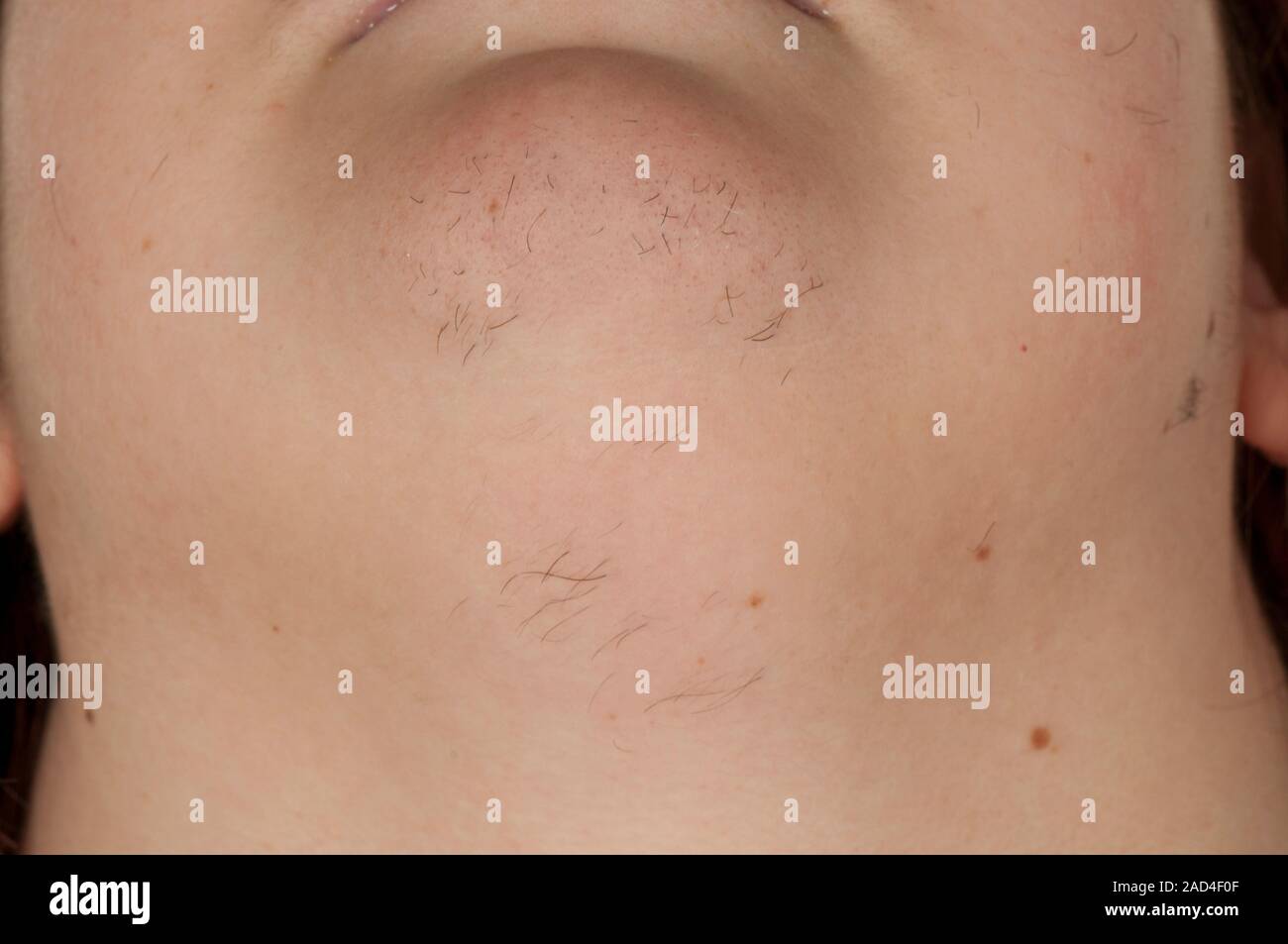 Excessive female facial hair growth. Close-up of excessive hair growth ...