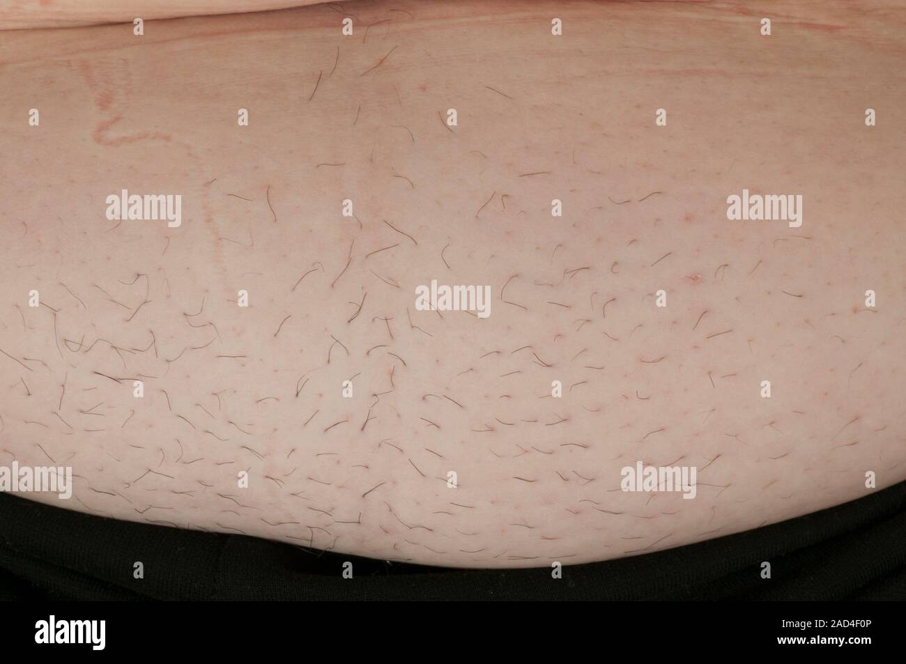 Excessive female facial hair growth. Close-up of excessive hair growth ...