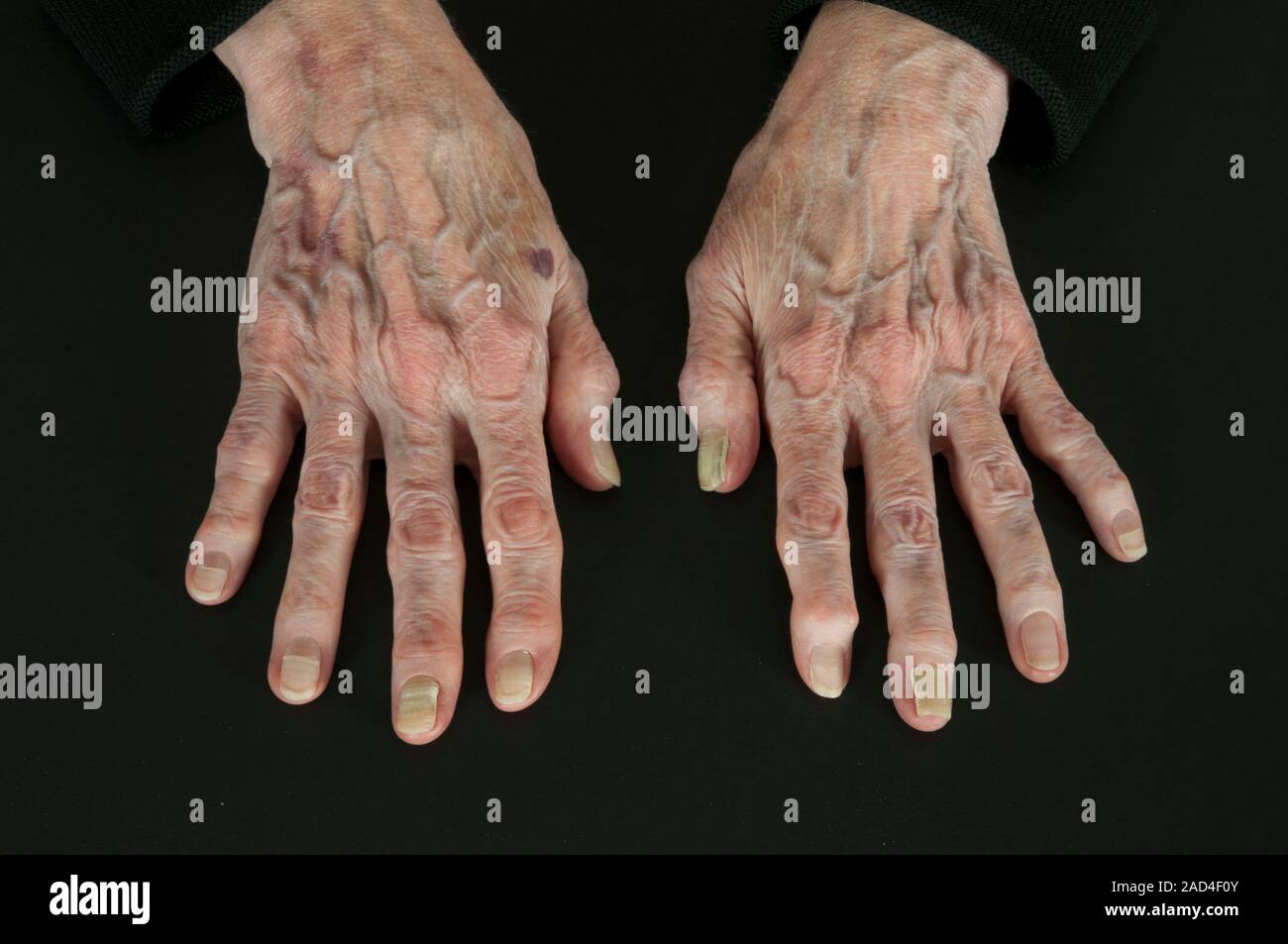 Yellow nail syndrome. Discoloured and damaged finger nails on the hands ...