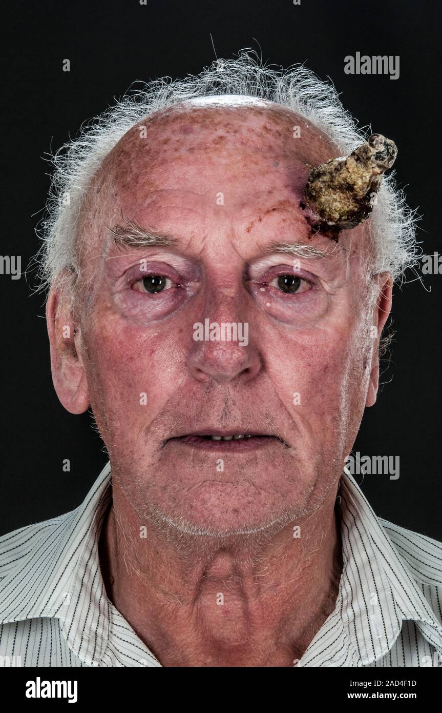 Cutaneous horn. Large cutaneous horn on the head of a 75-year-old male ...