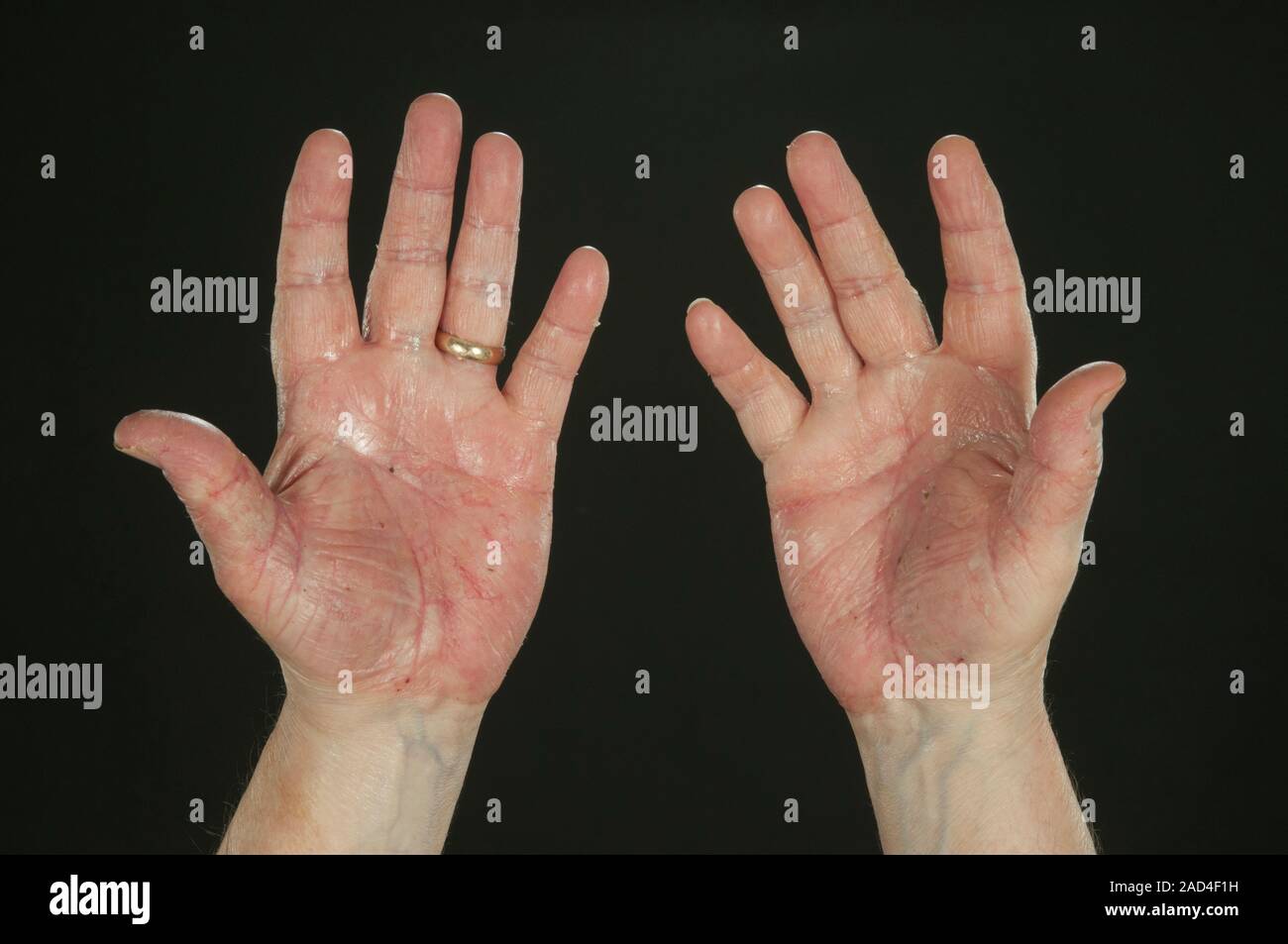 Psoriasis. Close-up of psoriasis affecting the hands of a 65-year-old ...