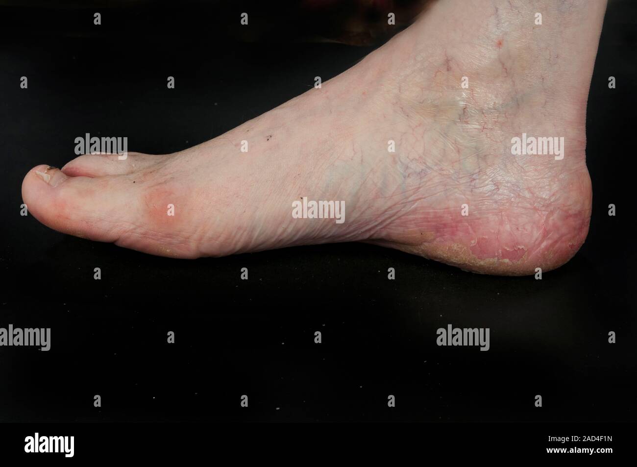 Psoriasis. Close-up of psoriasis affecting the foot of a 65-year-old ...