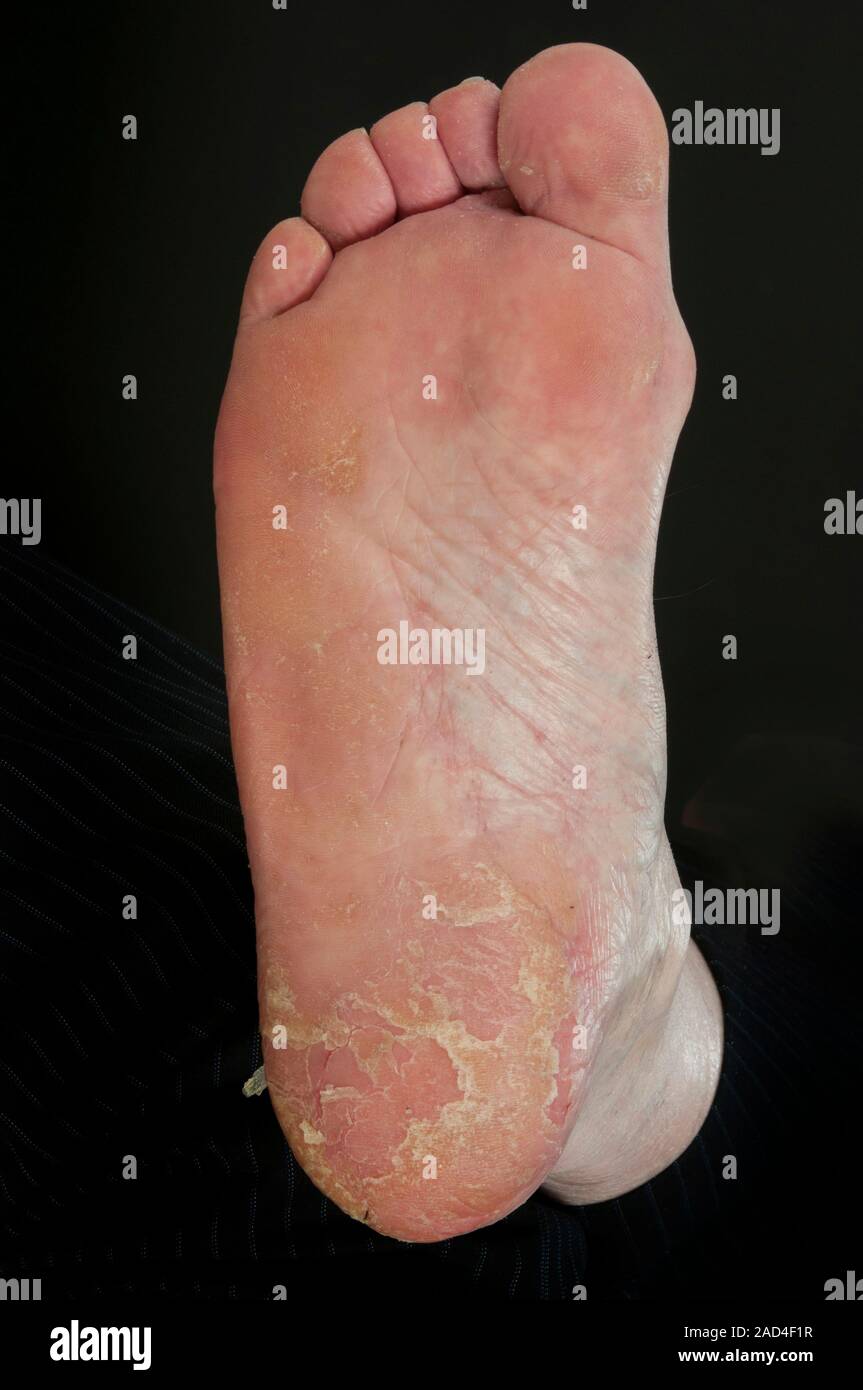 Psoriasis. Close-up of psoriasis affecting the foot of a 65-year-old ...