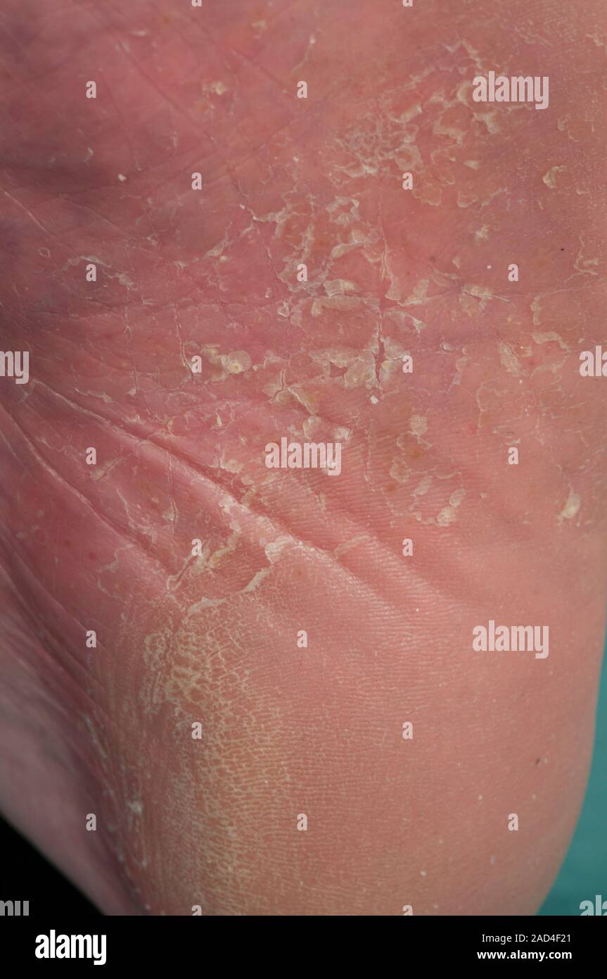 Psoriasis. Close-up of psoriasis affecting the foot of a 51-year-old ...
