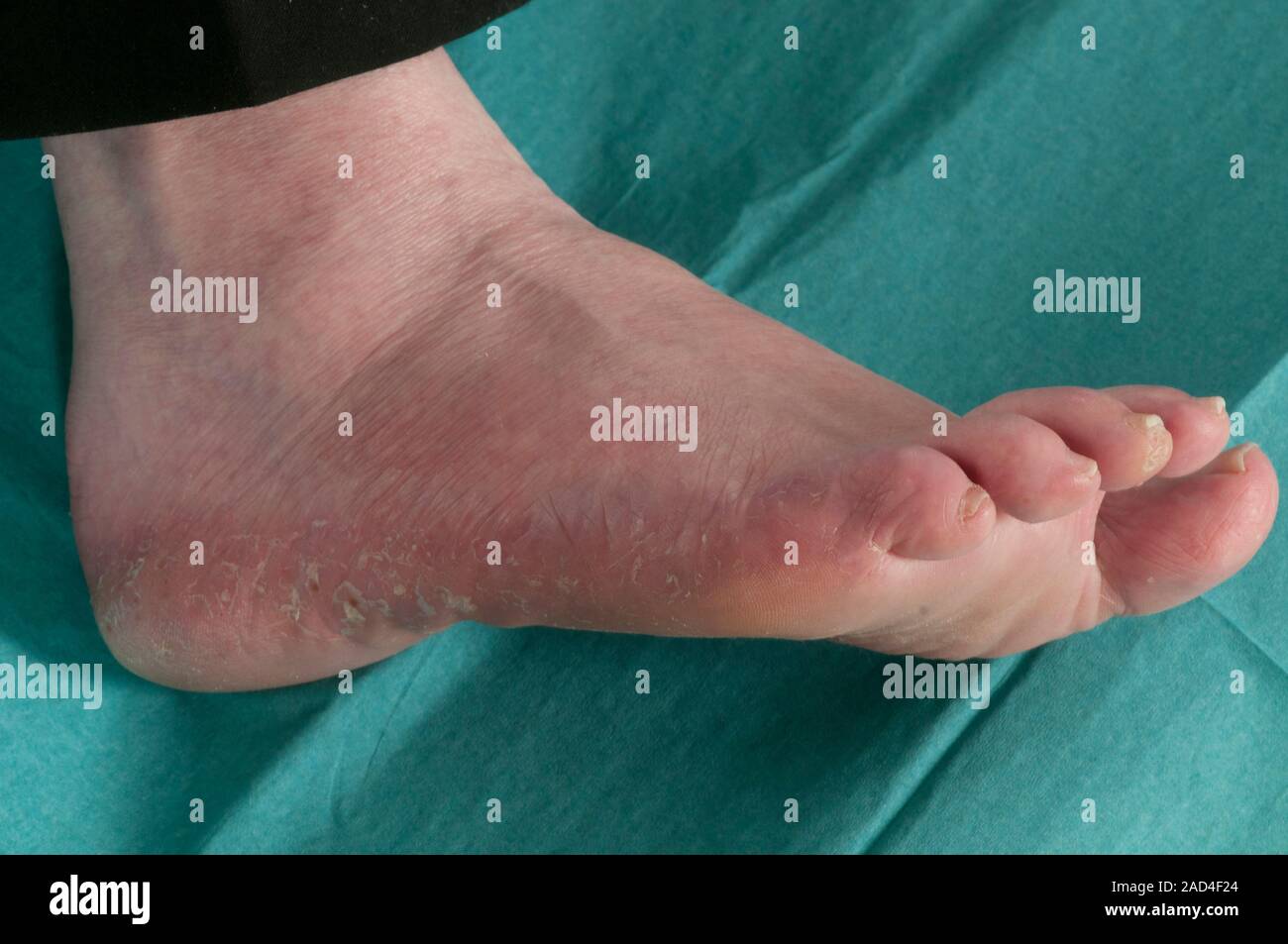 Psoriasis. Close-up of psoriasis affecting the foot of a 51-year-old ...