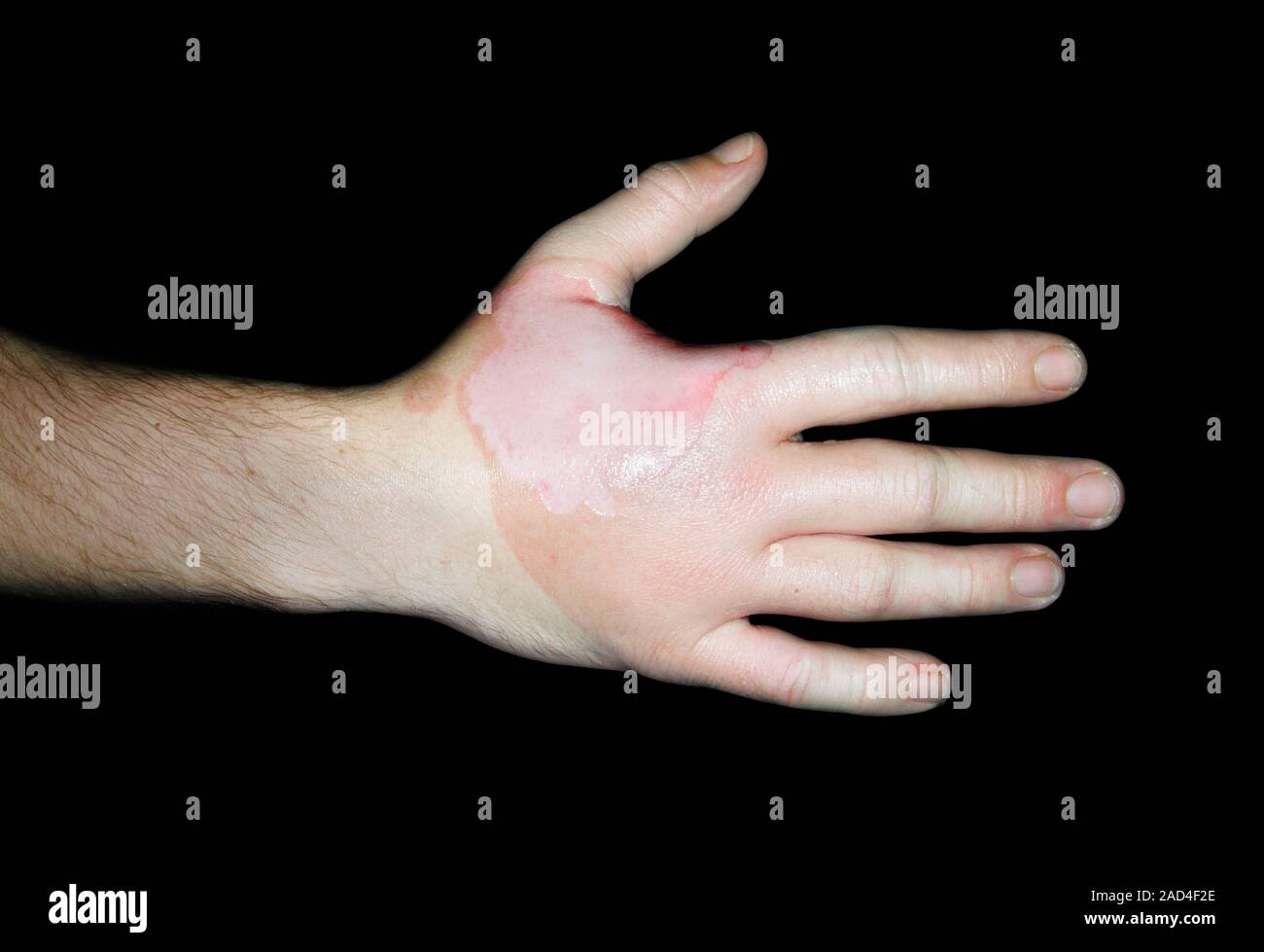 Scalded hand. Burn on the hand of a 29-year-old male patient who ...