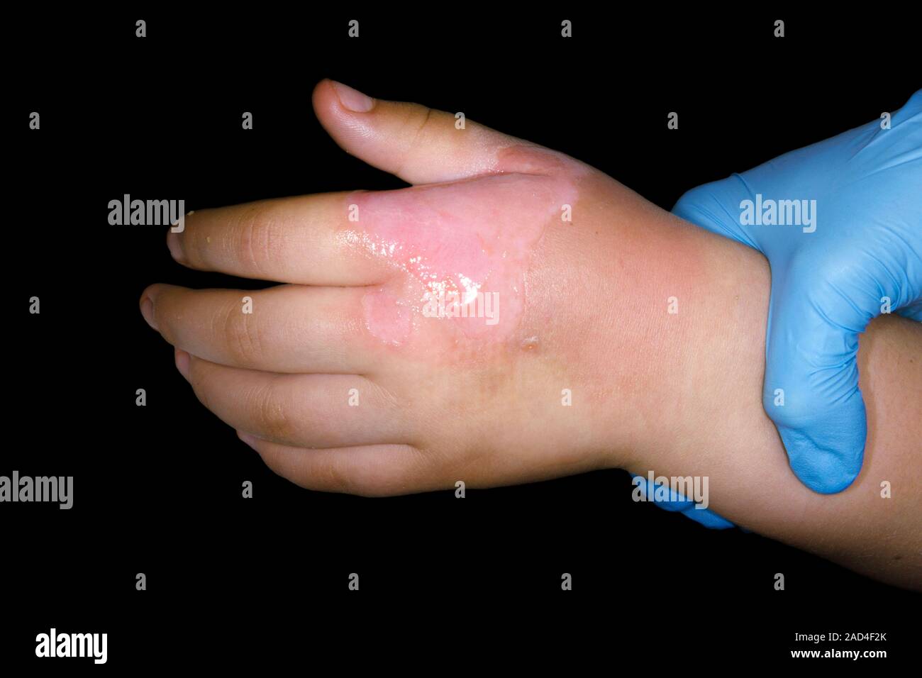 Scalded hand. Burn on the hand of a 13-year-old female patient who ...