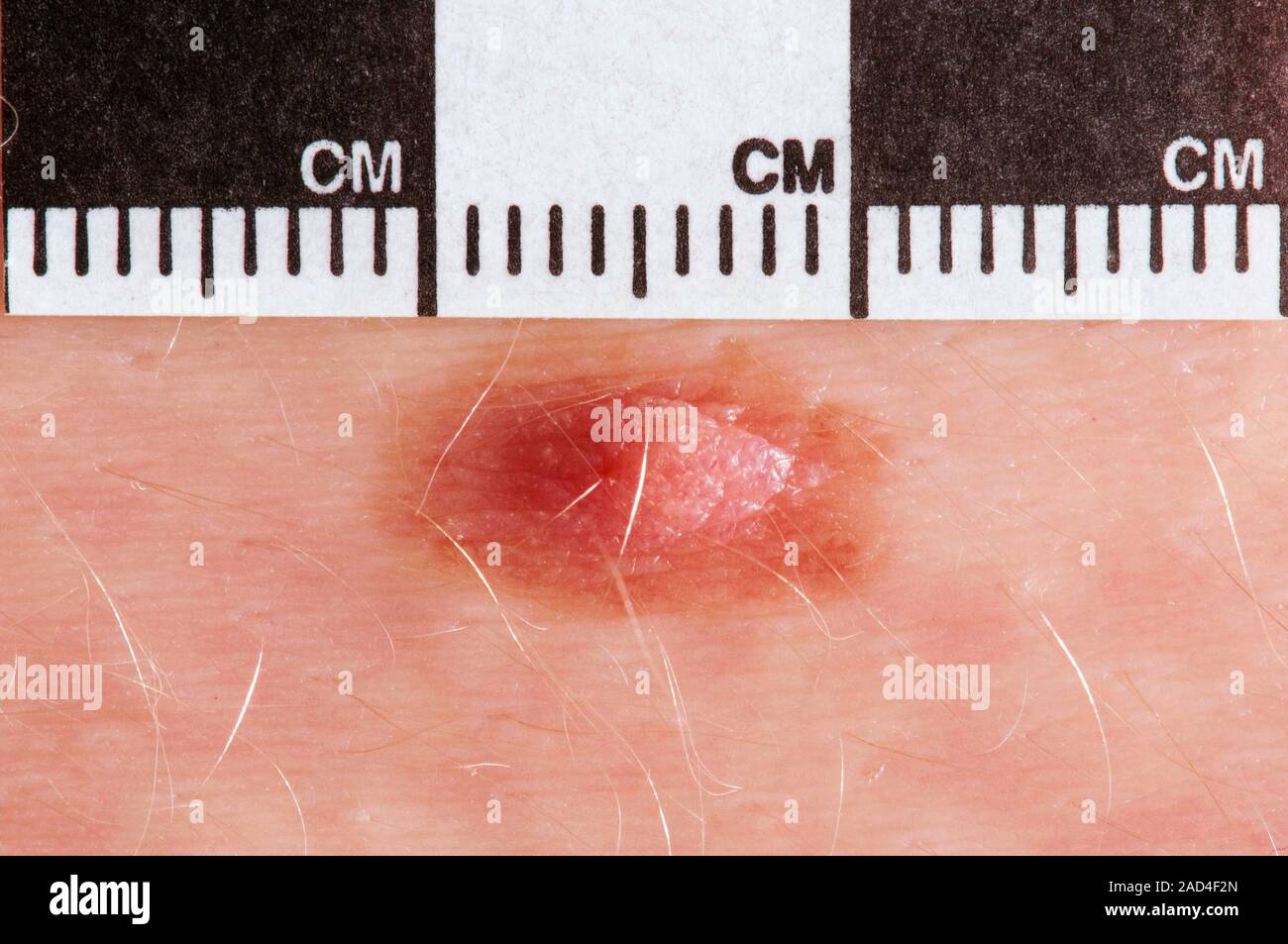 Mole. Dermatoscope image of a mole (naevus) on the back of a 33-year ...
