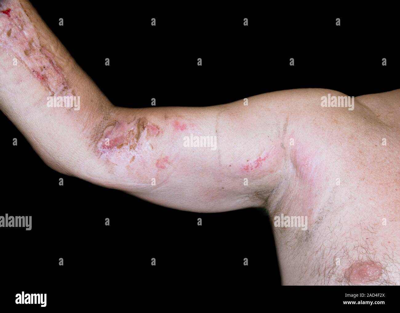 Petrol burn. Burn on the arm of a 72-year-old male patient, caused by ...