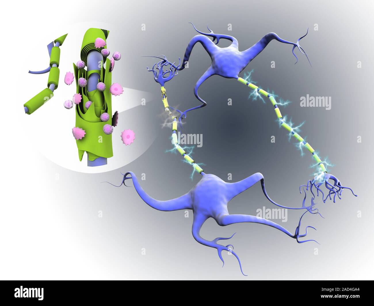 Nerve cells in multiple sclerosis. Computer illustration showing the ...
