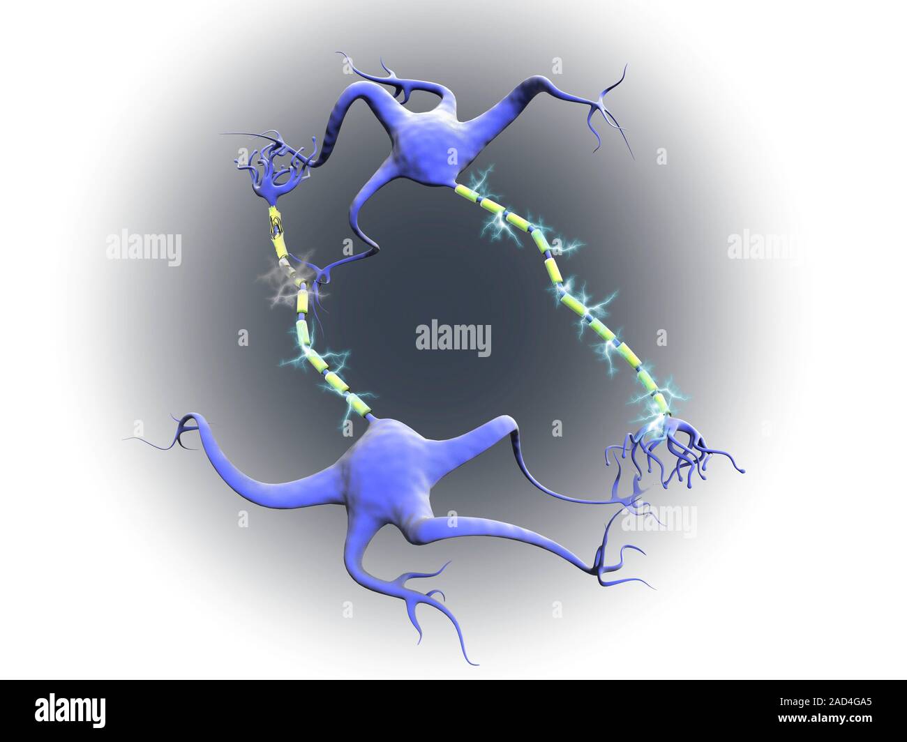 Nerve cells in multiple sclerosis. Computer illustration showing the ...