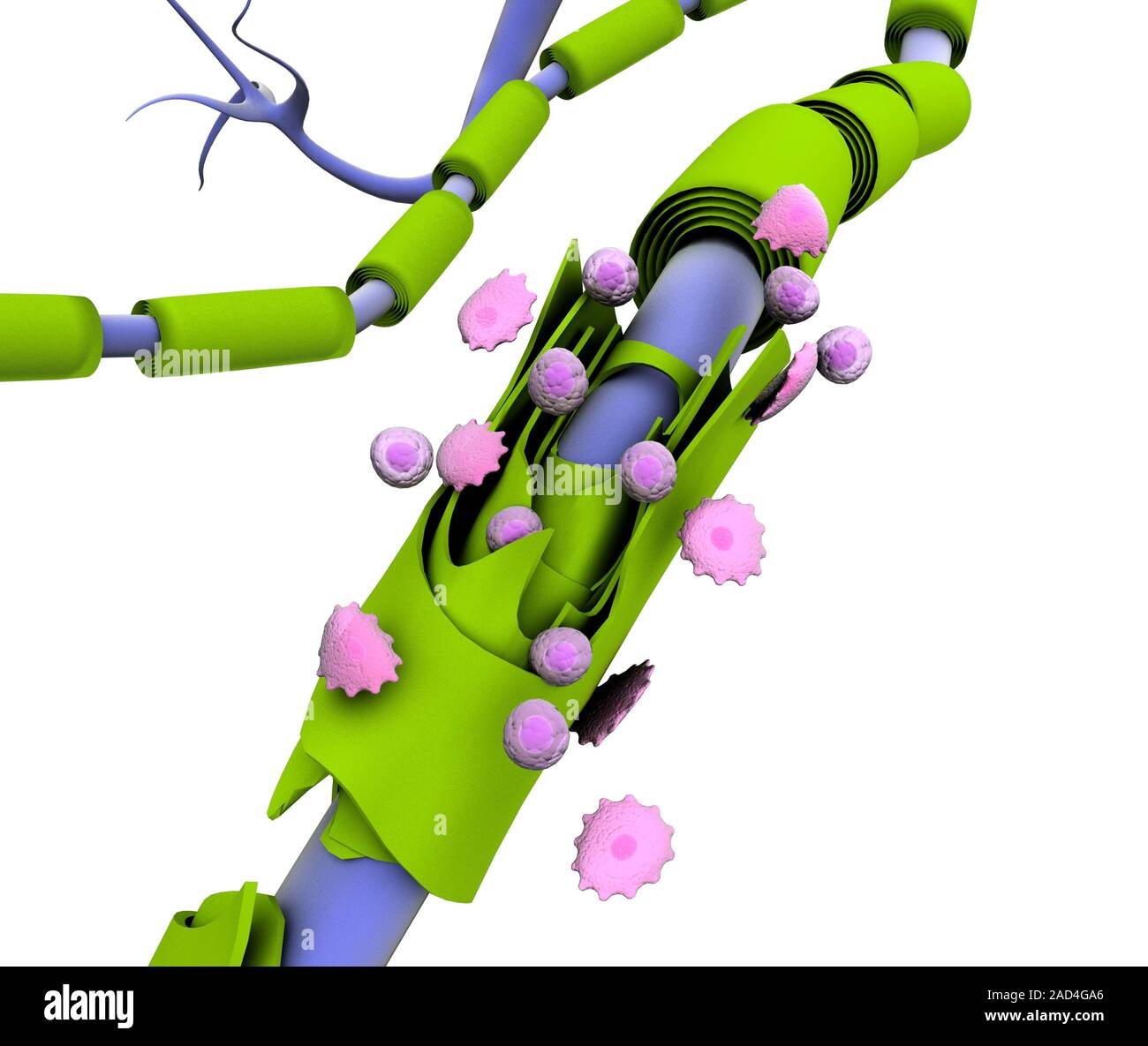 Nerve cells in multiple sclerosis. Computer illustration showing the ...