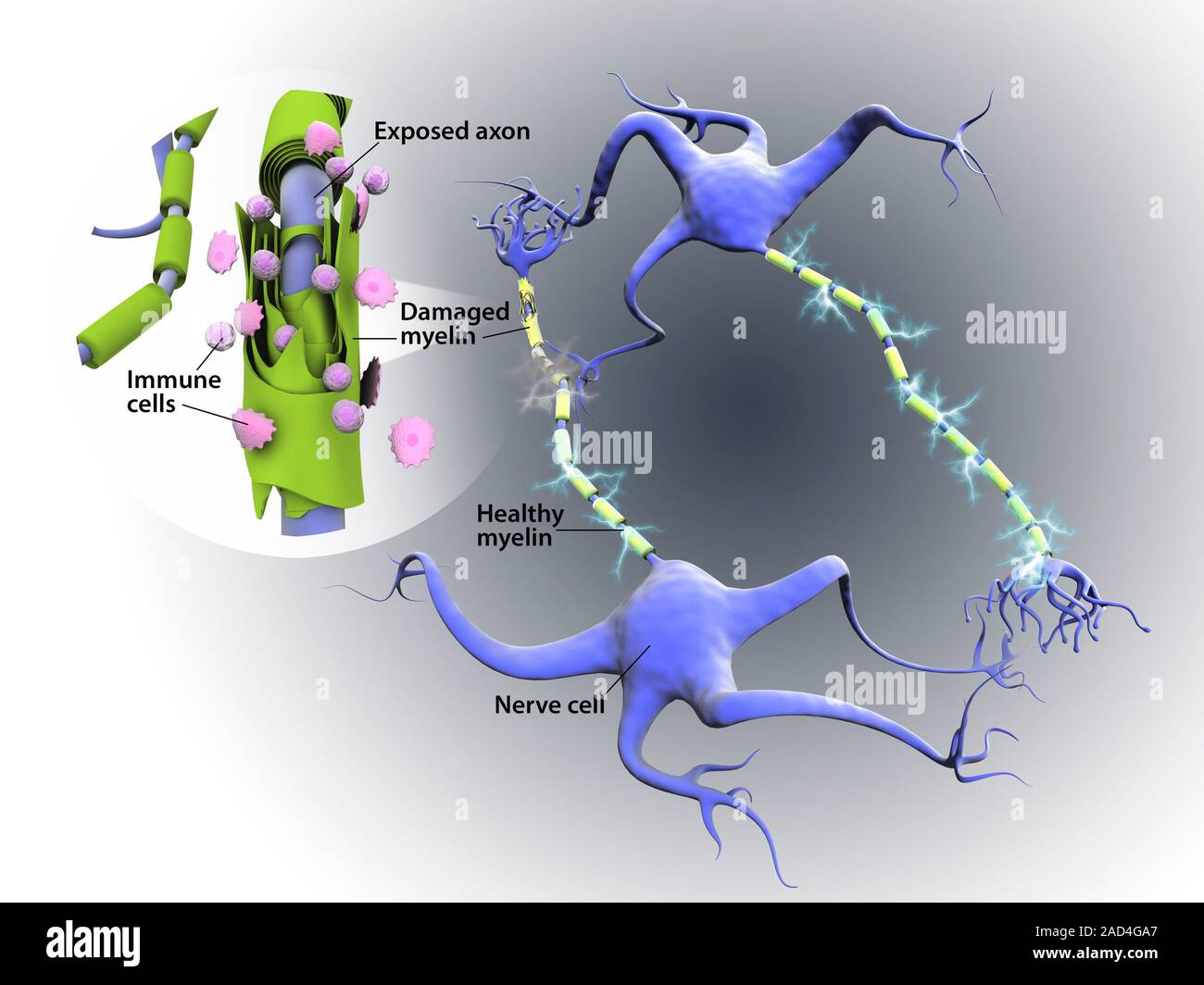 Nerve cells in multiple sclerosis. Computer illustration showing the ...