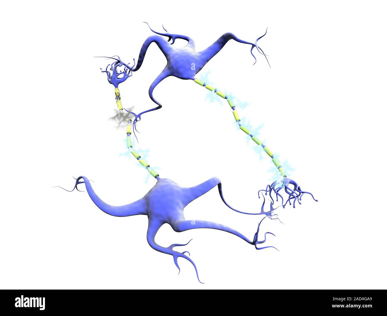 Nerve cells in multiple sclerosis. Computer illustration showing the ...