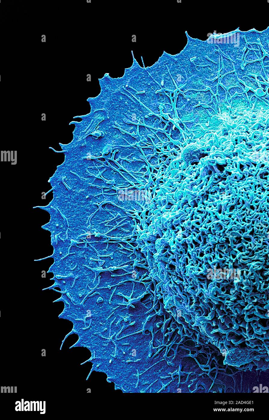 Colorectal cancer cell. Coloured scanning electron micrograph (SEM) of ...