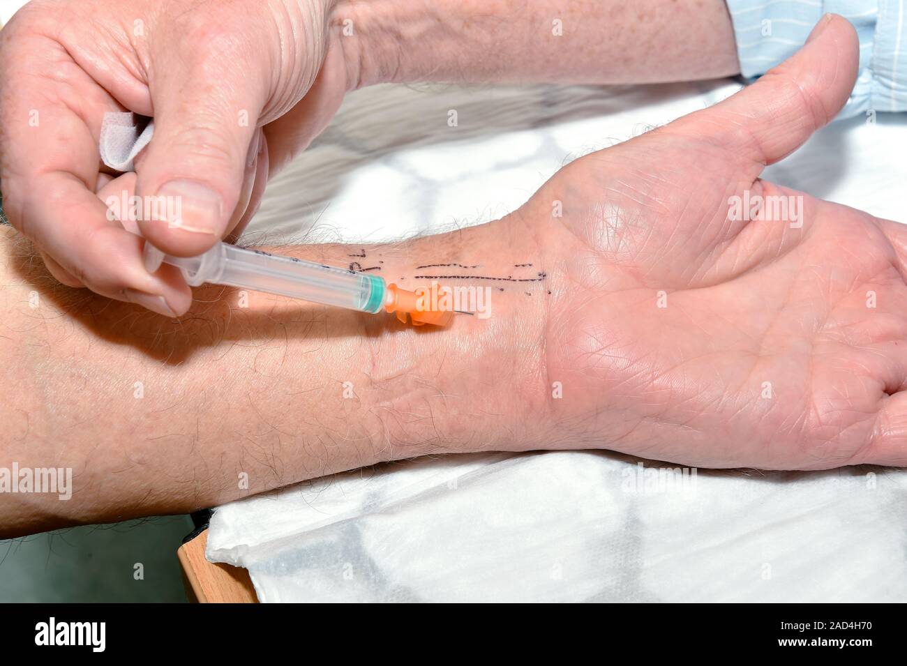 Carpal tunnel syndrome treatment. Patient with carpal tunnel syndrome ...