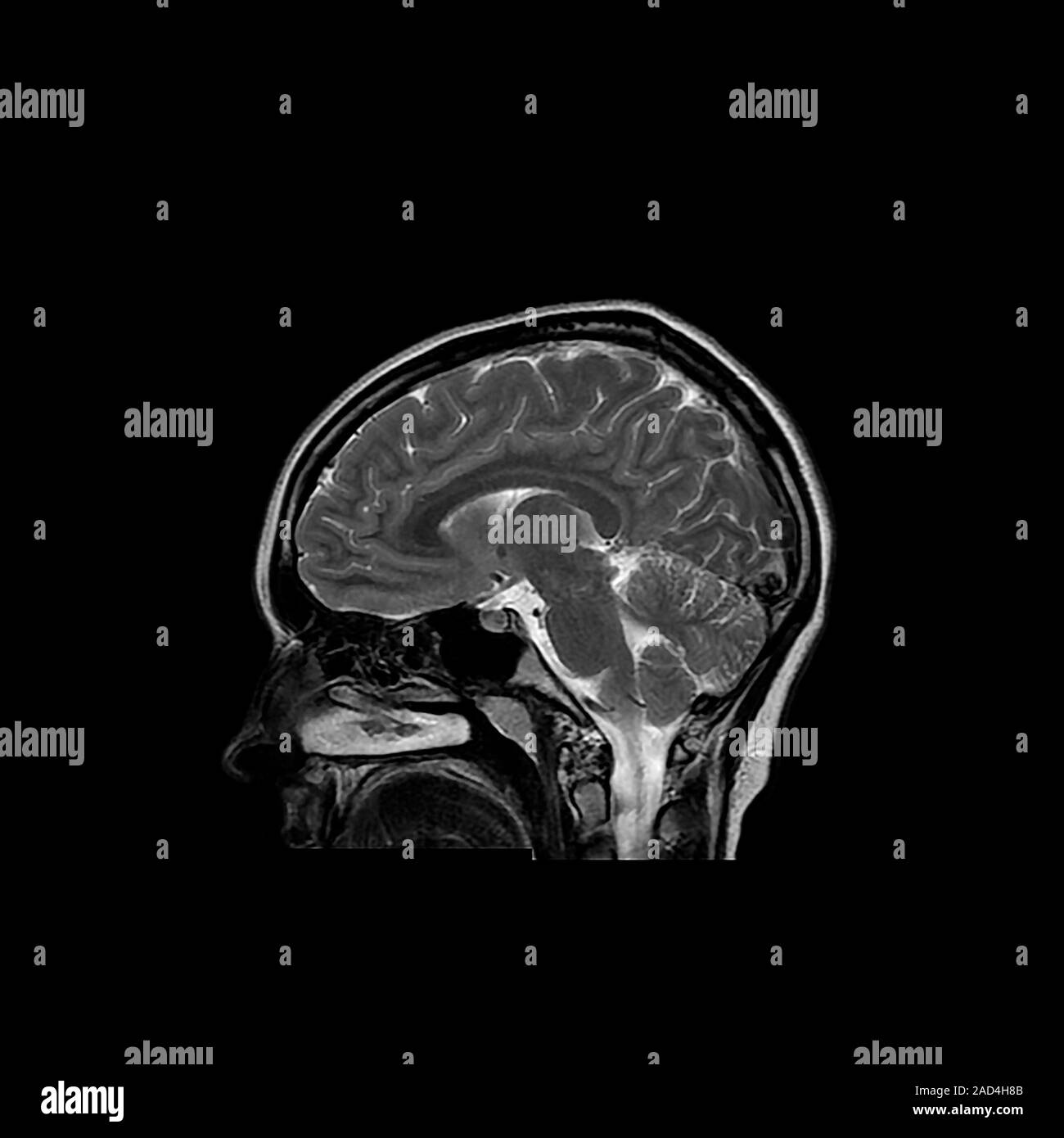 Teenage brain. Magnetic resonance imaging (MRI) scan of a sagittal ...