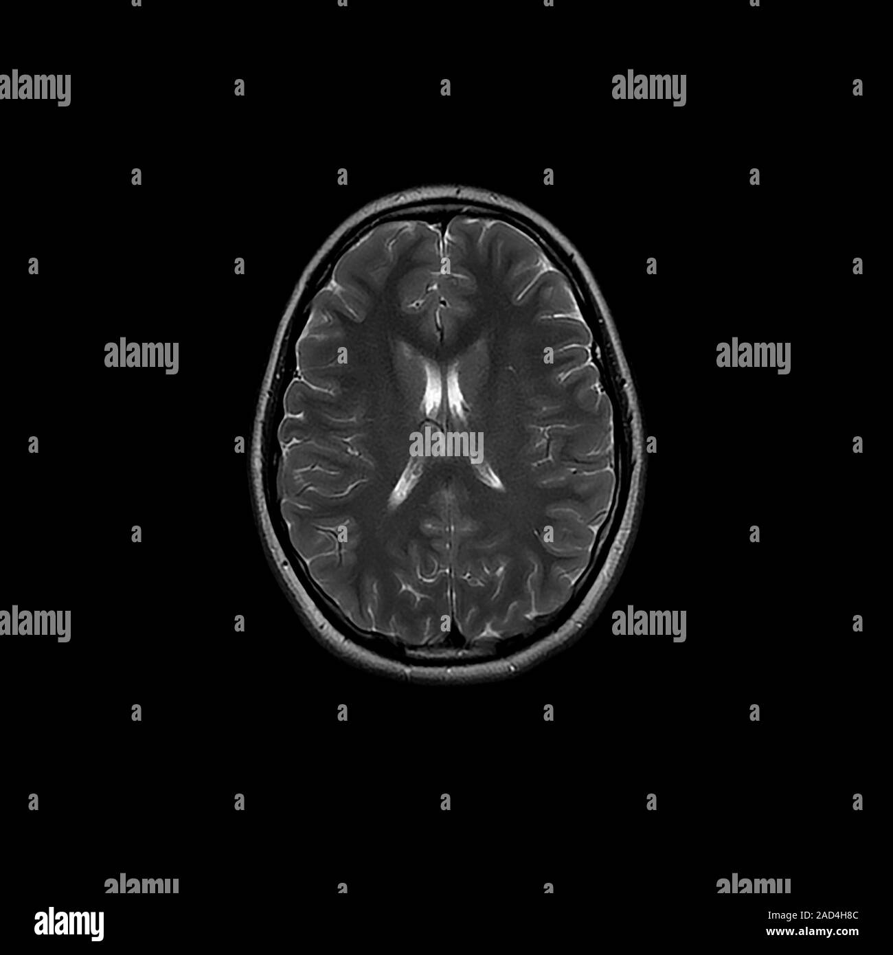 Teenage brain. Magnetic resonance imaging (MRI) scan of a transverse ...