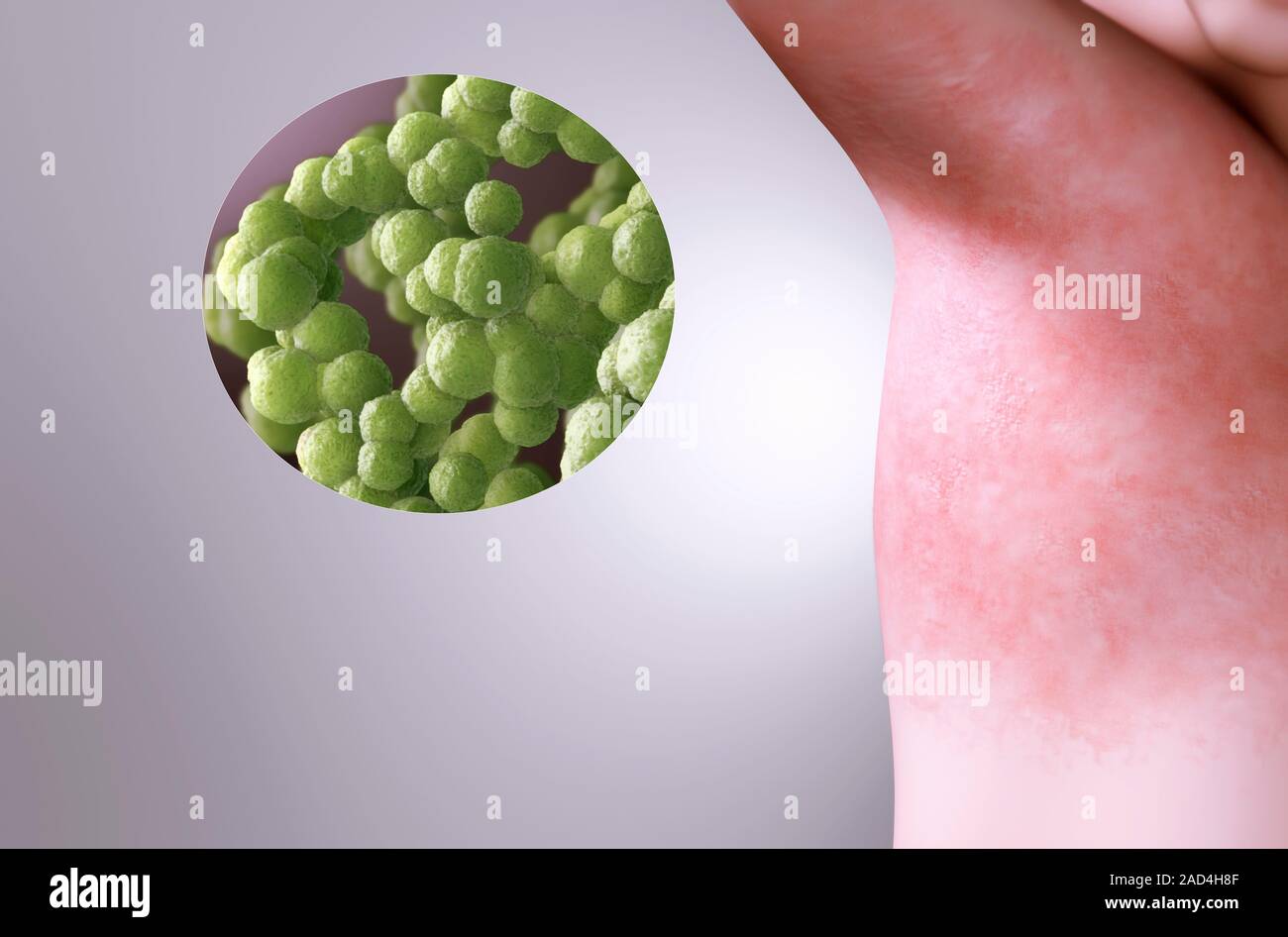 Scarlet fever. Illustration of a child with the disease scarlet fever ...