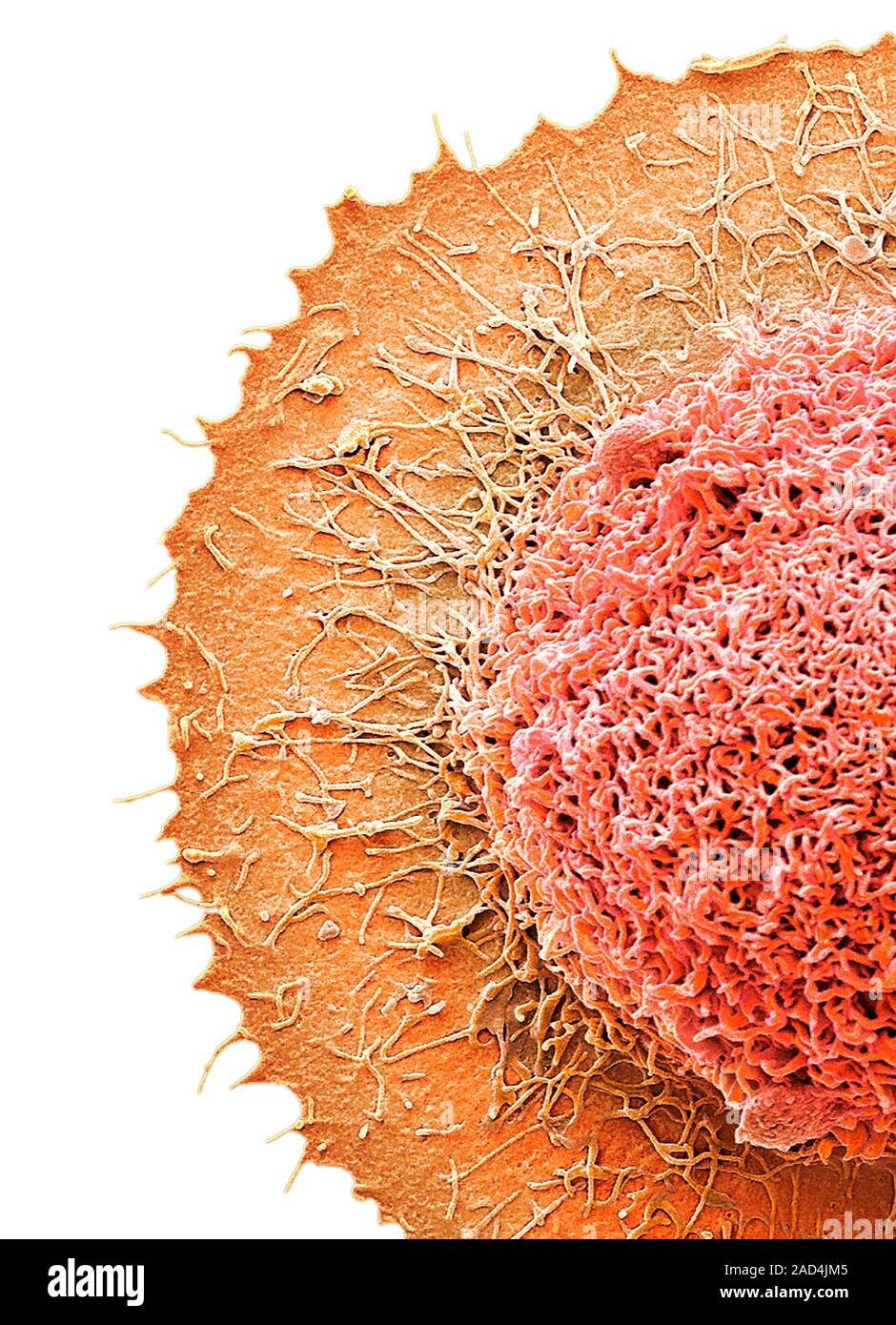 Colorectal cancer cell. Coloured scanning electron micrograph (SEM) of ...