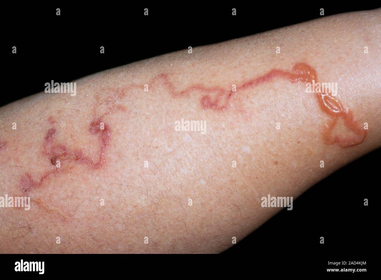 Cutaneous larva migrans infection. Close-up of the skin of a patient ...