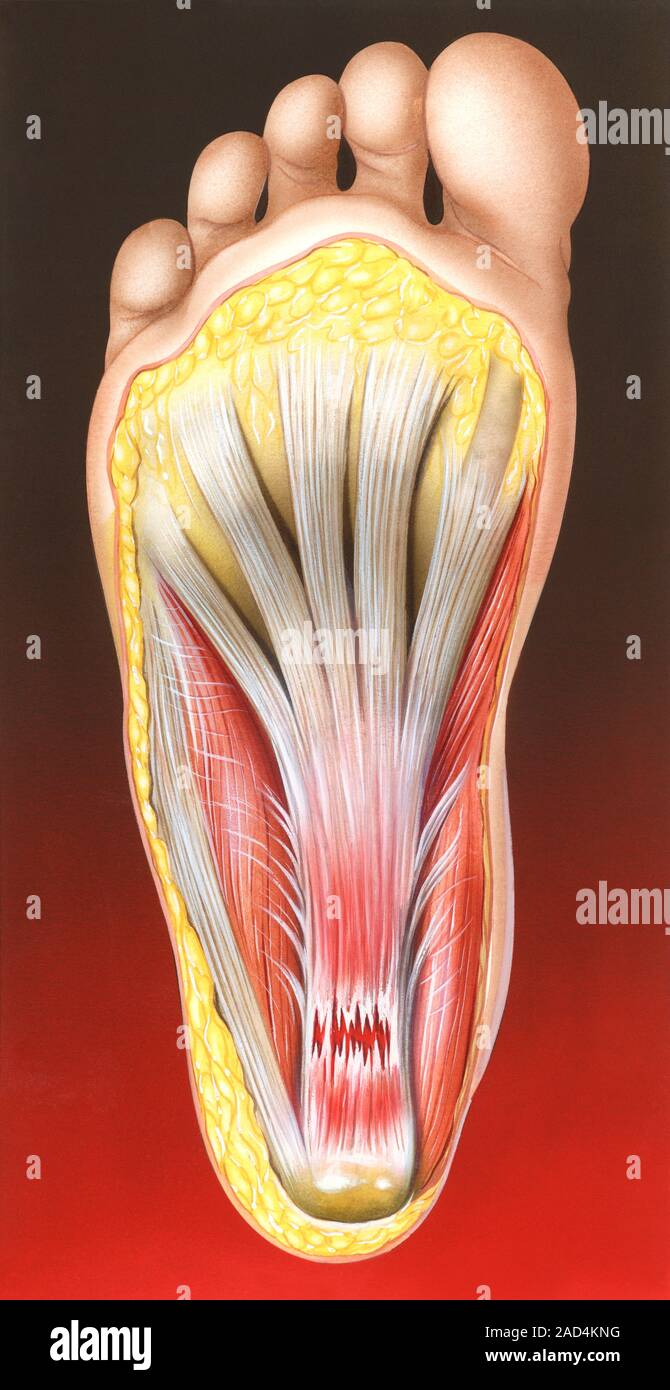 Plantar fasciitis. Illustration of the connective tissue of the underside of the foot in a case ...