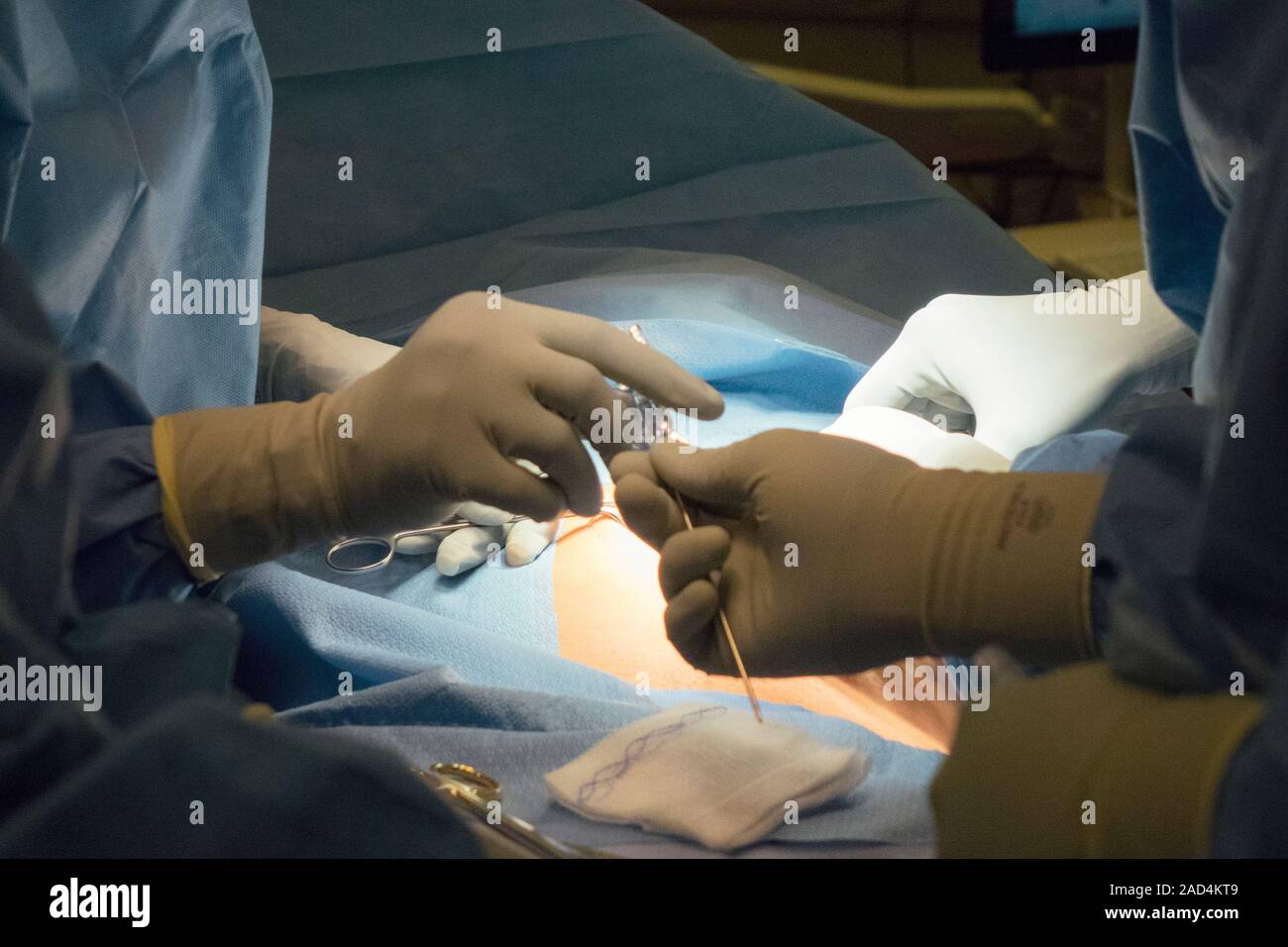 Laparoscopic appendectomy. Close-up of surgeons preparing to insert a ...