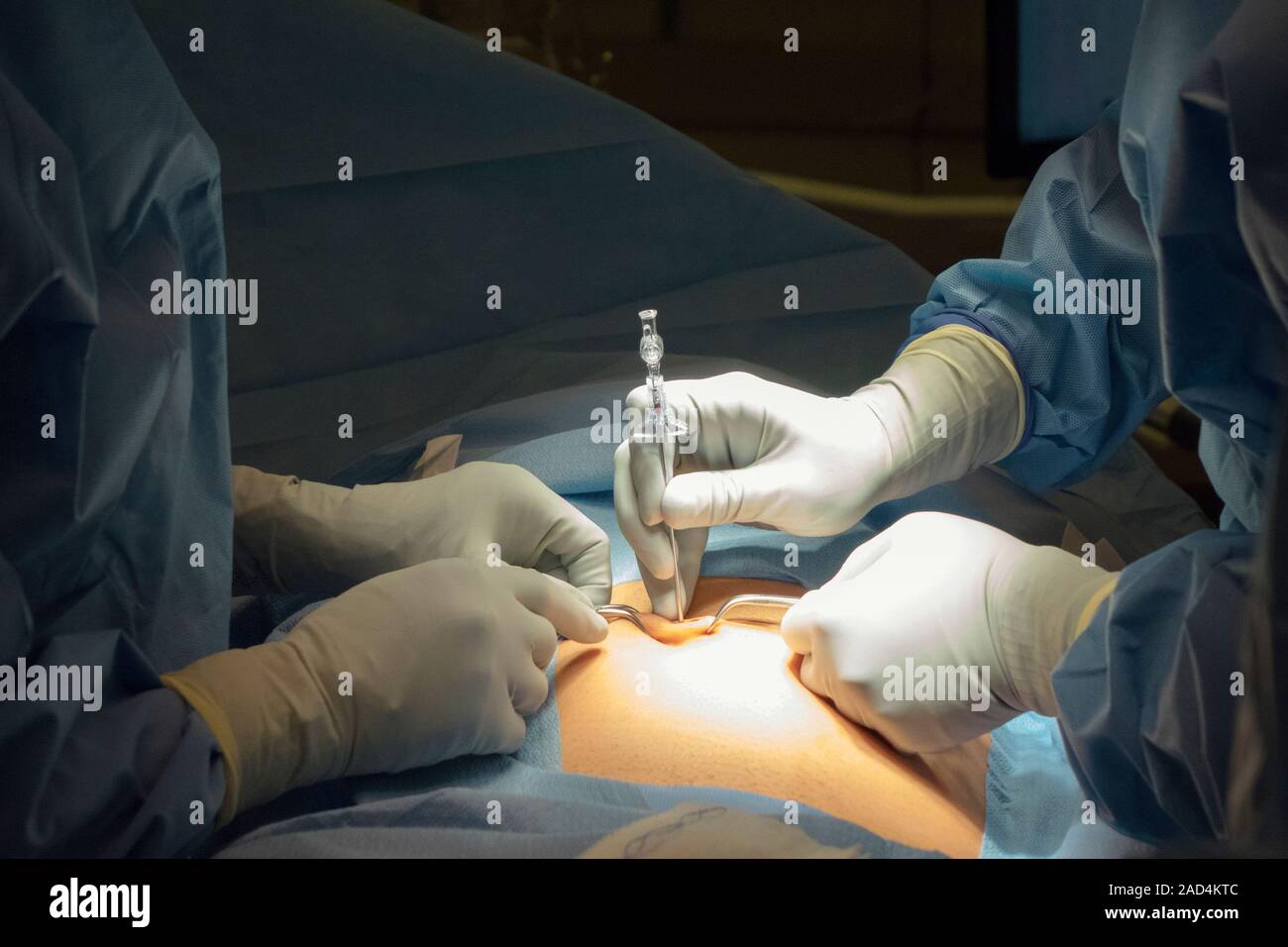 Laparoscopic appendectomy. Close-up of surgeons inserting a Veress ...
