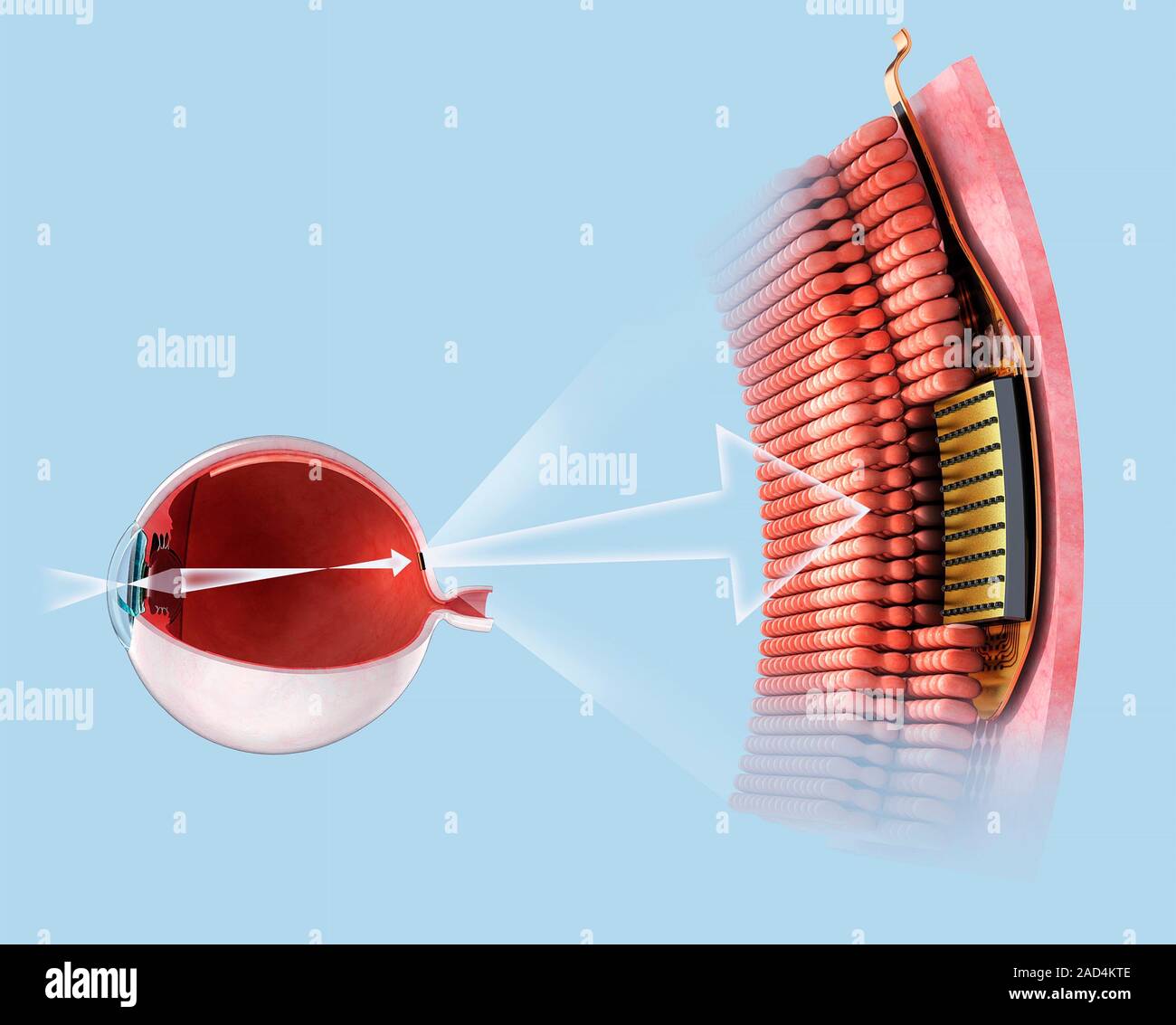 Bionic retina. Computer illustration of a visual prosthesis implanted ...