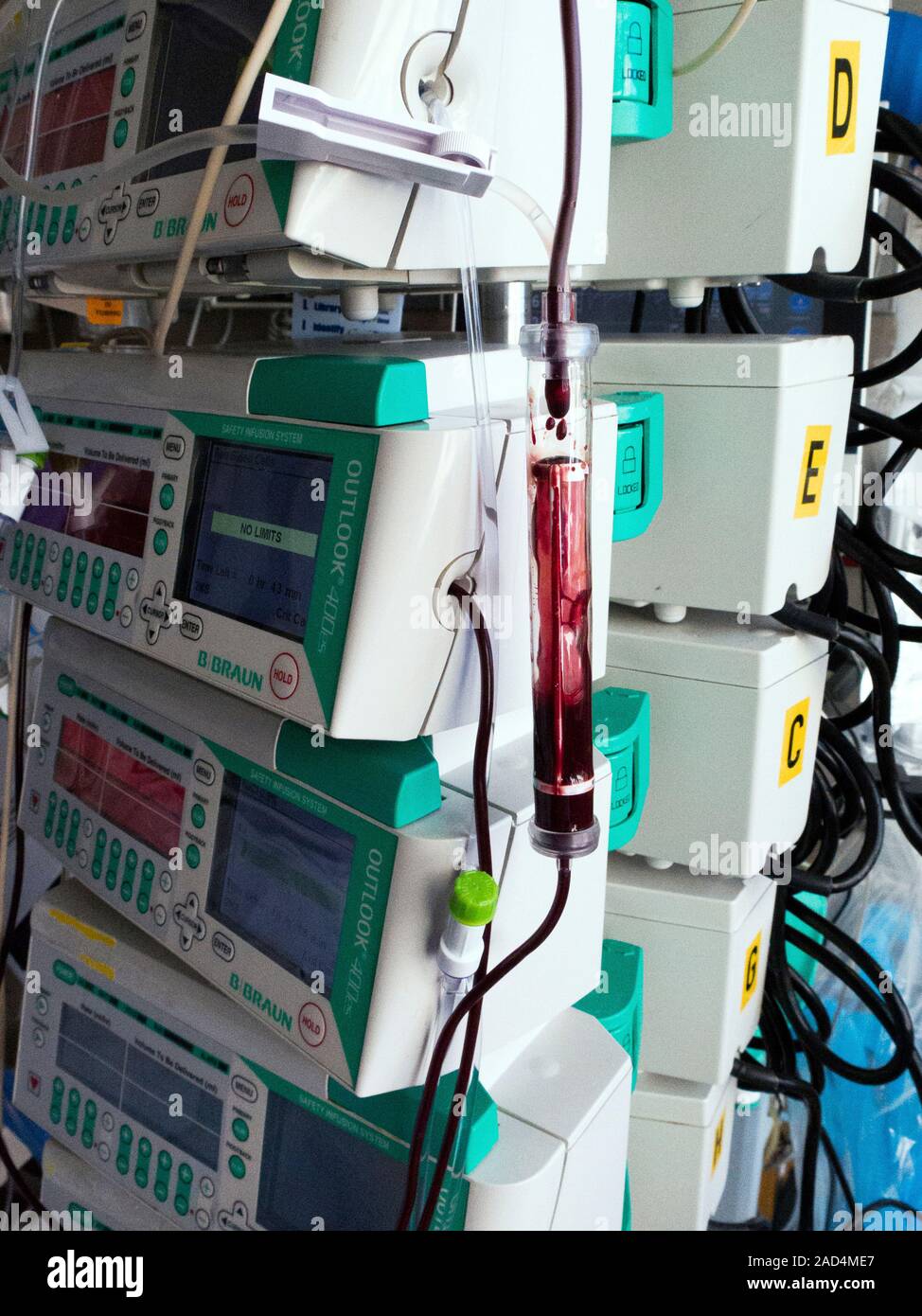 Intensive care unit blood transfusion. Drip chamber (centre) with blood ...