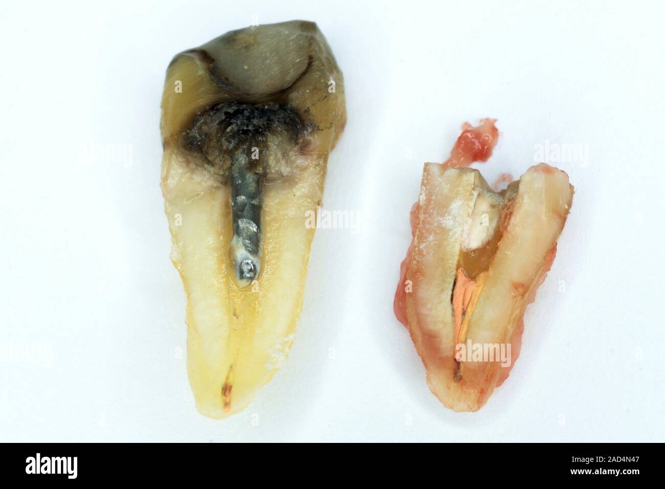 Extracted premolar tooth and root. Sectioned views of an extracted ...