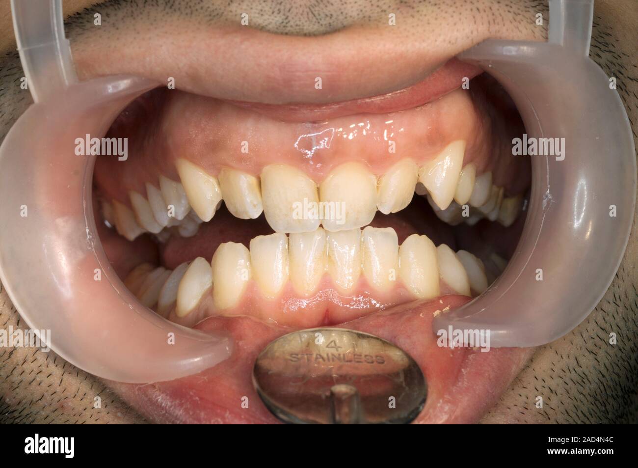 Traumatic overbite. Close-up of the mouth of a 23-year-old man with ...