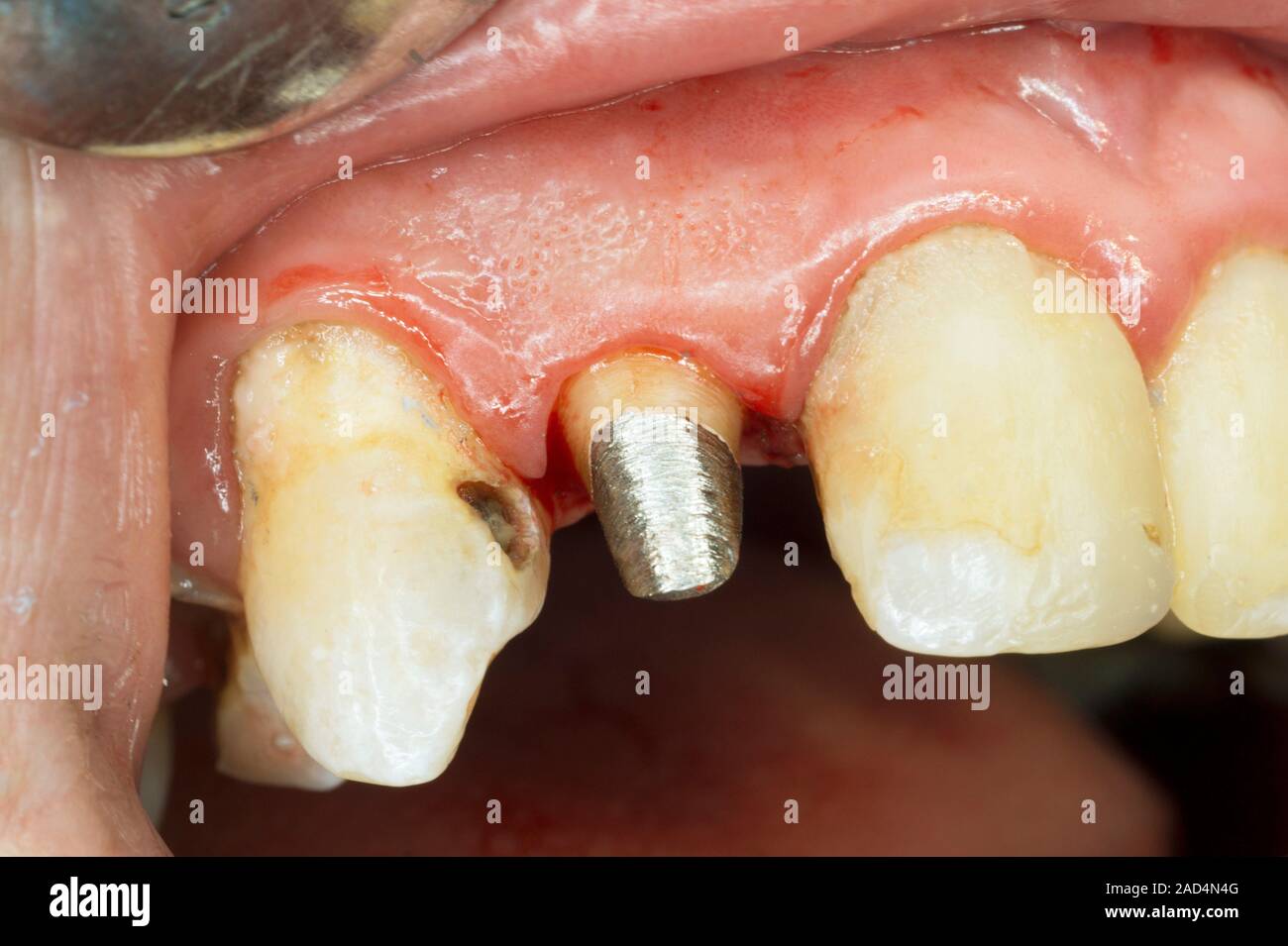 Upper incisor with post for dental crown. Close-up of the upper ...